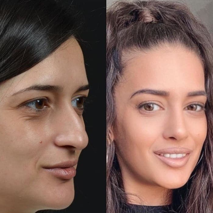 Revision Aesthetic Nose Surgery - TurkCure