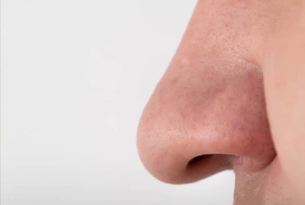 Types of Noses: Changes of The Nose under Rhinoplasty - TurkCure