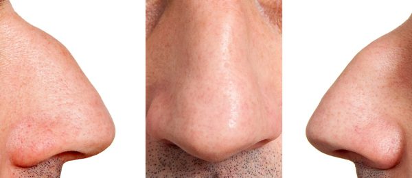 Types of Noses: Changes of The Nose under Rhinoplasty - TurkCure